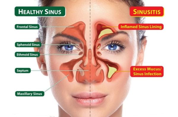 Functional Endoscopic Sinus Surgery - Patient Experts